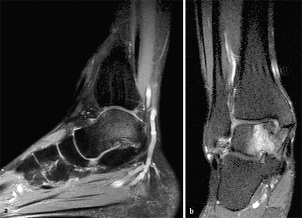 Das Knochenmarködemsyndrom (KMÖS) | SpringerLink