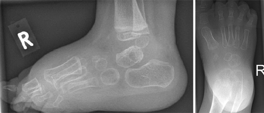 Talus verticalis | SpringerLink