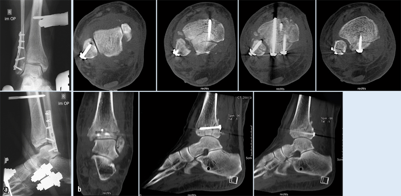 Frakturversorgung des oberen Sprunggelenks im hohen Lebensalter ...
