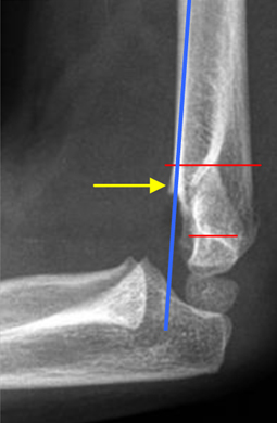 Distale Humerusfrakturen beim Kind | SpringerLink