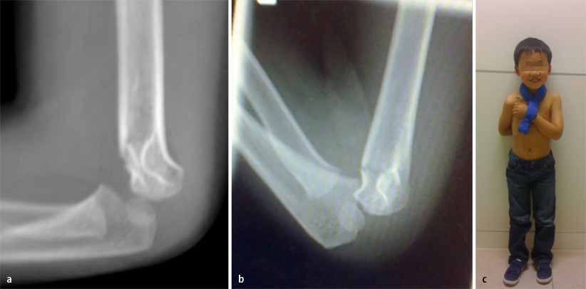 Distale Humerusfrakturen beim Kind | SpringerLink