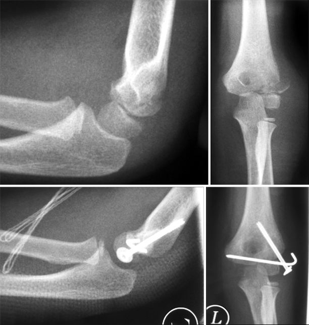 Distale Humerusfrakturen beim Kind | SpringerLink