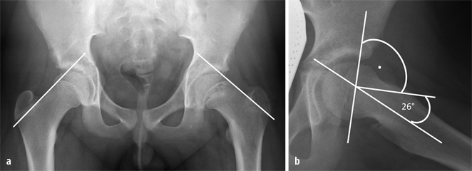 Epiphyseolysis capitis femoris | SpringerLink