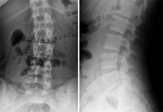 Spondylosclerosis hemispherica | SpringerLink