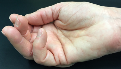 Diagnostik der Beugesehnenverletzungen der Hand | SpringerLink