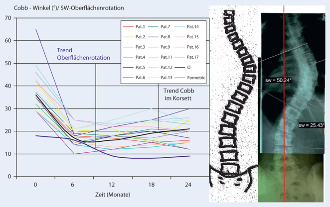 Konservative Behandlung der idiopathischen Skoliose | SpringerLink