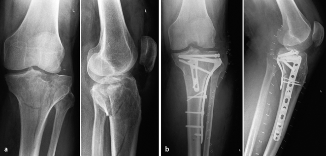 Outcome und Komplikationen nach proximalen Tibiafrakturen | SpringerLink