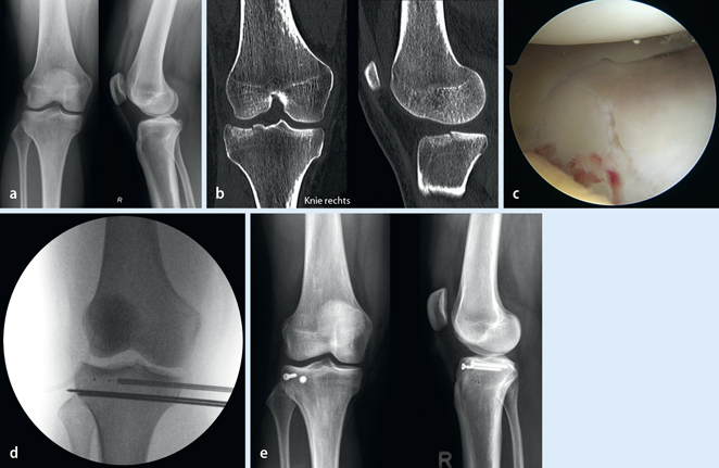 Outcome und Komplikationen nach proximalen Tibiafrakturen | SpringerLink