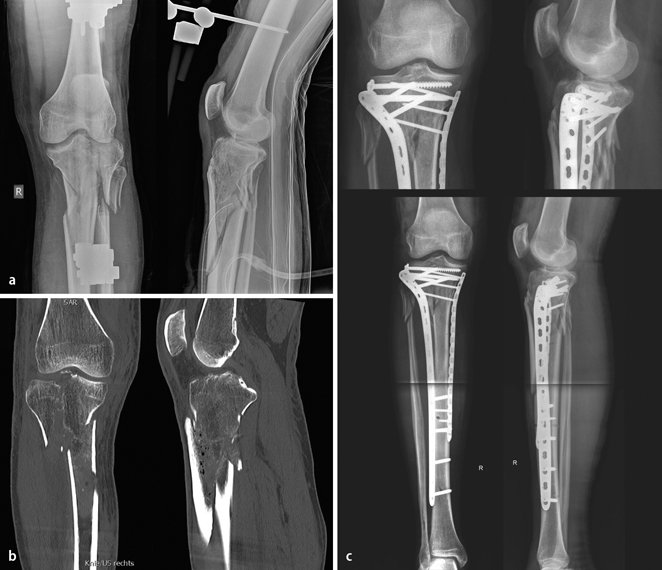 Outcome und Komplikationen nach proximalen Tibiafrakturen | SpringerLink