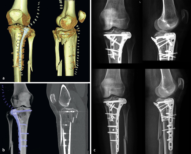 Outcome und Komplikationen nach proximalen Tibiafrakturen | SpringerLink