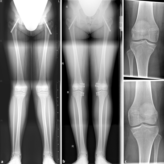 Behandlung der chronischen Epiphyseolysis capitis femoris | SpringerLink