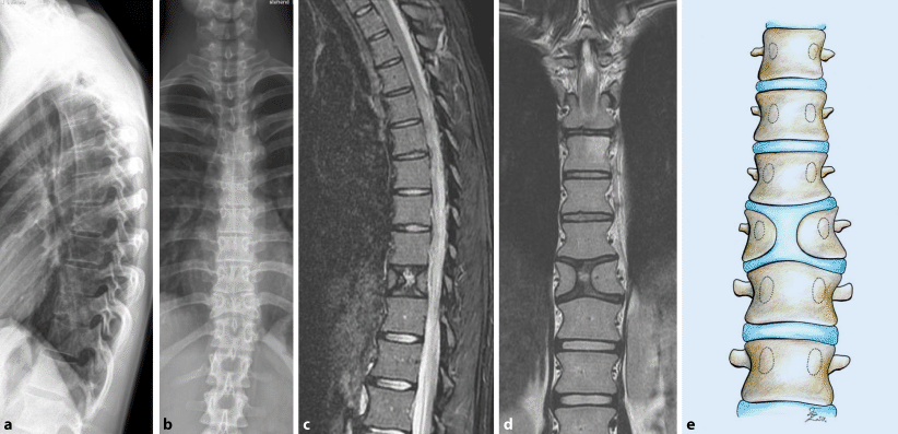 Kongenitale Fehlbildungen der Wirbelsäule im Wachstum | SpringerLink