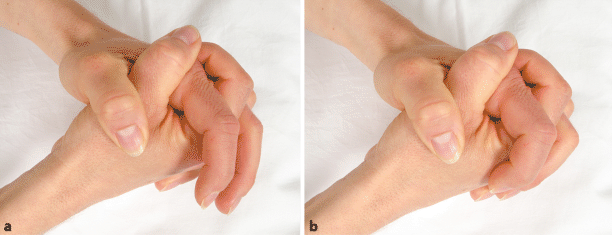 Klinische Untersuchung des Handgelenkes und der Hand | SpringerLink