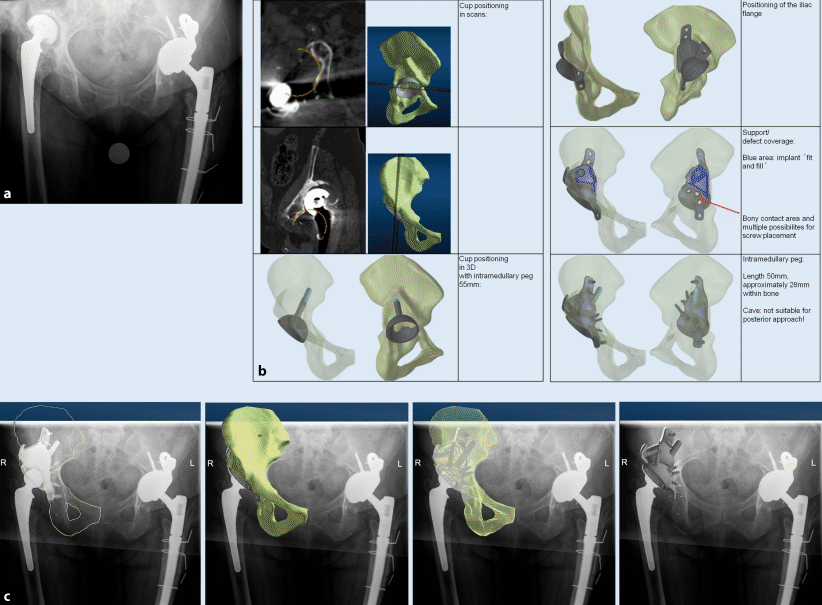 Acetabular defect classification in times of 3D imaging and patient ...