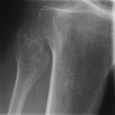 Konventionell-radiologische Diagnose von gutartigen Knochentumoren ...