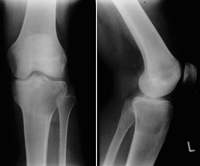 Konventionell-radiologische Diagnose von gutartigen Knochentumoren ...
