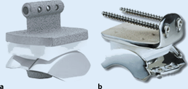 Arthrose des oberen Sprunggelenks | SpringerLink