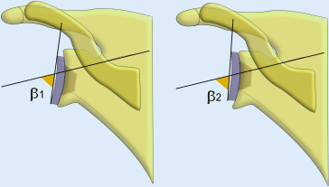 Superior glenoid inclination and glenoid bone loss | SpringerLink