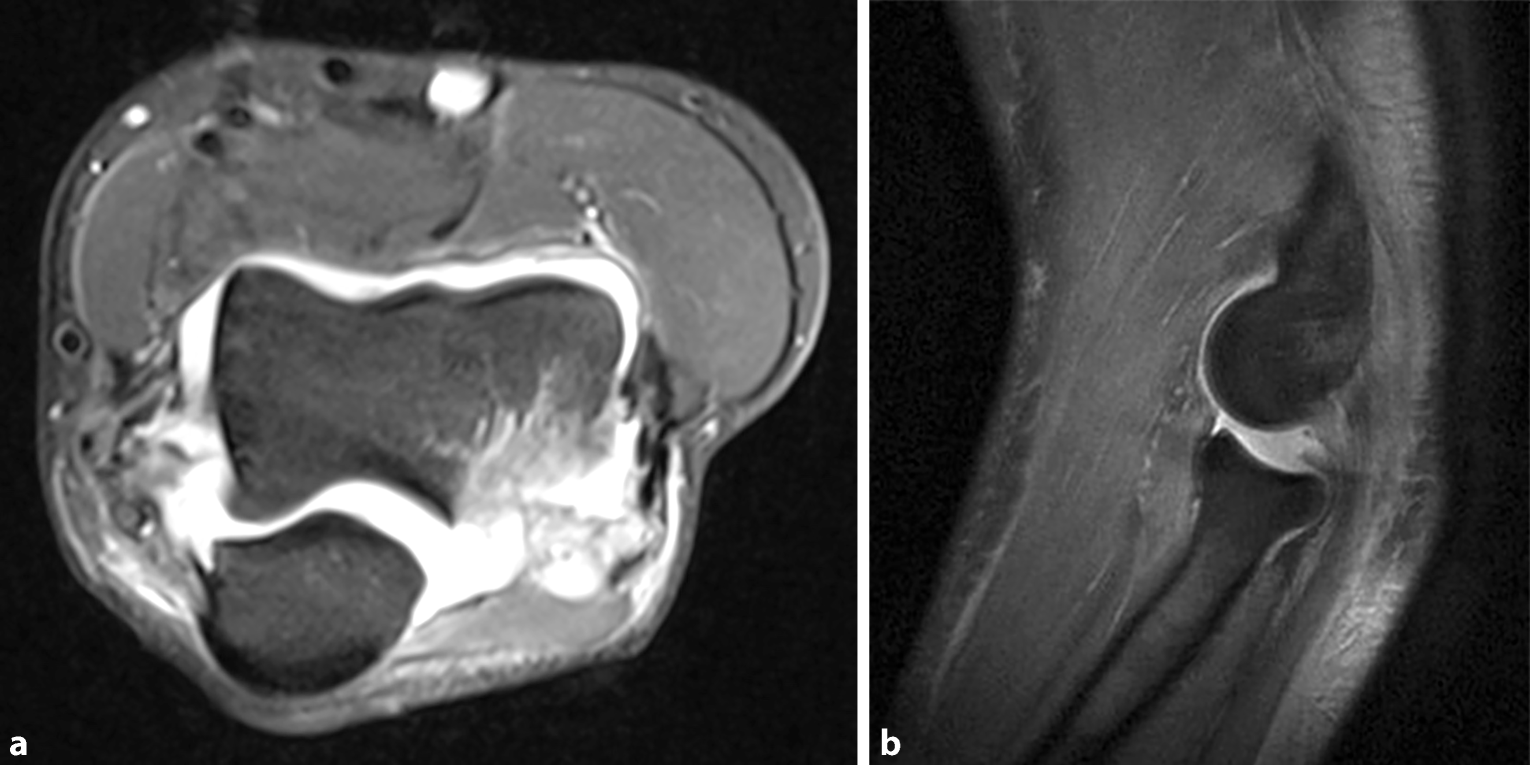 Akute und chronische Instabilitäten des Ellenbogengelenkes | SpringerLink