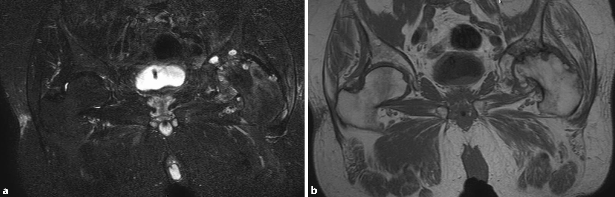 Das Knochenmarködem – Differenzialdiagnose zur aseptischen ...