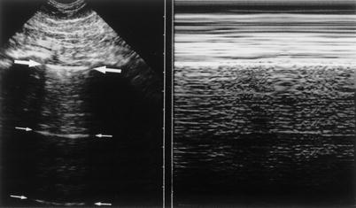 The “lung pulse”: an early ultrasound sign of complete atelectasis ...