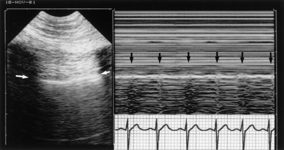 The “lung pulse”: an early ultrasound sign of complete atelectasis ...