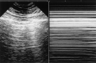 The “lung pulse”: an early ultrasound sign of complete atelectasis ...