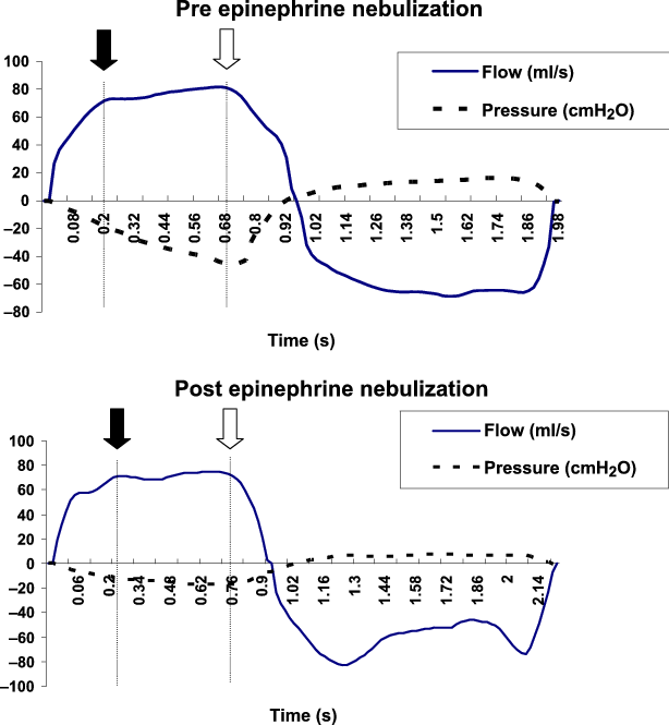 The effect of epinephrine by nebulization on measures of airway ...