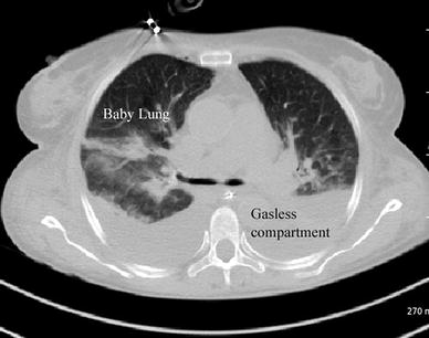 The "baby lung" became an adult | SpringerLink