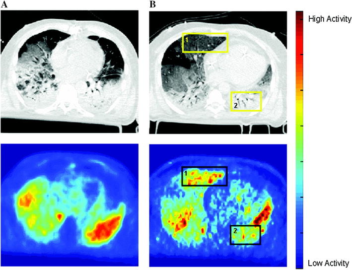 The "baby lung" became an adult | SpringerLink