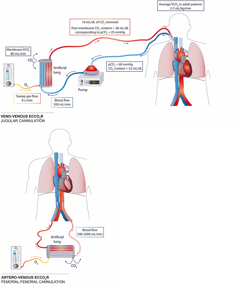 Extracorporeal carbon dioxide removal (ECCO2R) in patients with acute ...