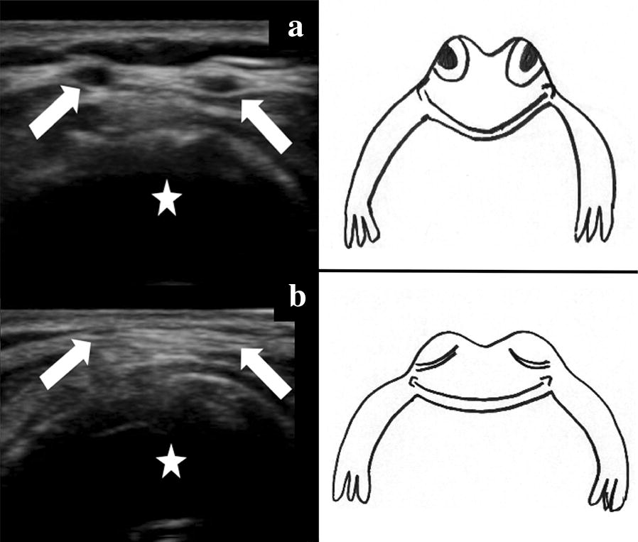 The ‘blinking frog’ ultrasound sign establishes the presence of ...