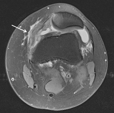 Bildgebende Diagnostik des Patellofemoralgelenks | SpringerLink