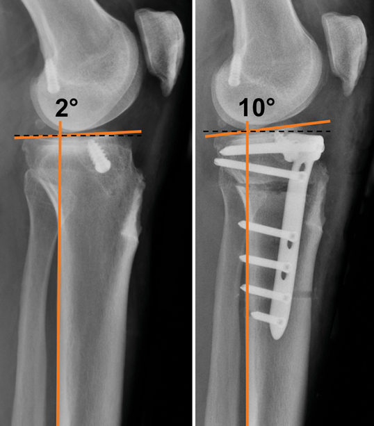 Hohe tibiale Osteotomie bei Varusgonarthrose | SpringerLink