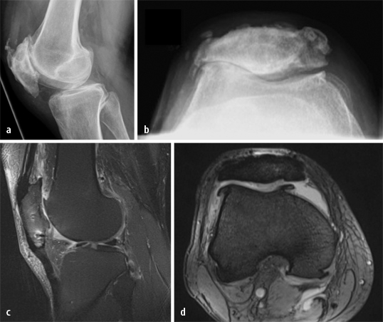 Die patellofemorale Arthrose | SpringerLink