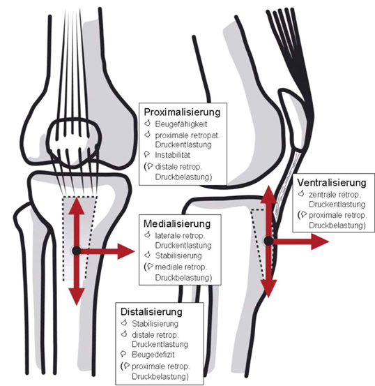Die patellofemorale Arthrose | SpringerLink
