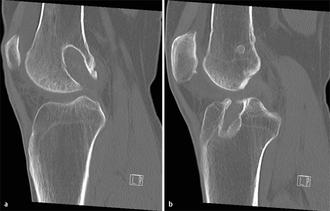 Intraoperative biologische Augmentation am Knochen und der ...