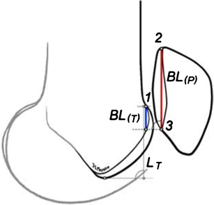 The patellotrochlear index: a new index for assessing patellar height ...
