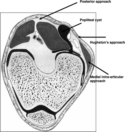 The popliteal cyst | SpringerLink