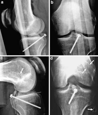 Screw fixation of a 4 1/2-year-old PCL avulsion injury | SpringerLink