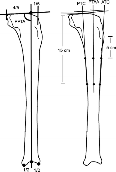 Tibial slope and high tibial osteotomy using the circular external ...