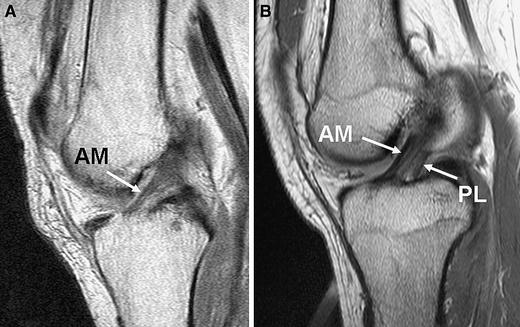 Assessment of normal ACL double bundle anatomy in standard viewing ...