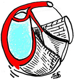 Slap lesion type IV and a Buford complex: a case report | SpringerLink