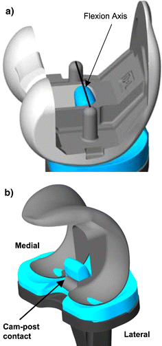Patient function after a posterior stabilizing total knee arthroplasty ...