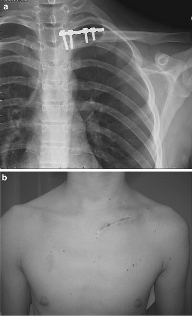 Sternoclavicular physeal fracture associated with adjacent clavicle ...