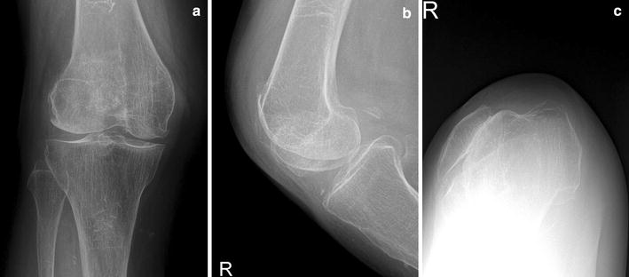 TKA using the subvastus approach and lateral retinacular release in ...