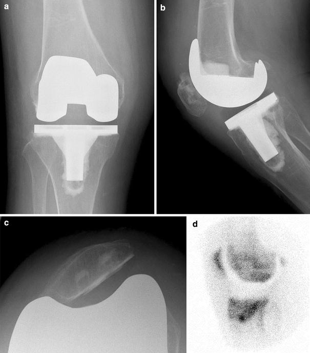 TKA using the subvastus approach and lateral retinacular release in ...