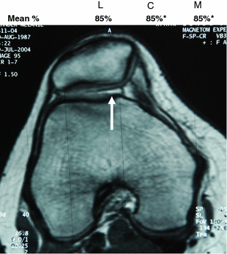 Anterior–posterior trochlear measurements of normal and dysplastic ...