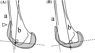The risk of notching the anterior femoral cortex with the use of ...