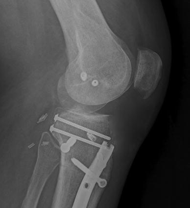 PCL reconstruction with the tibial inlay technique following intra ...